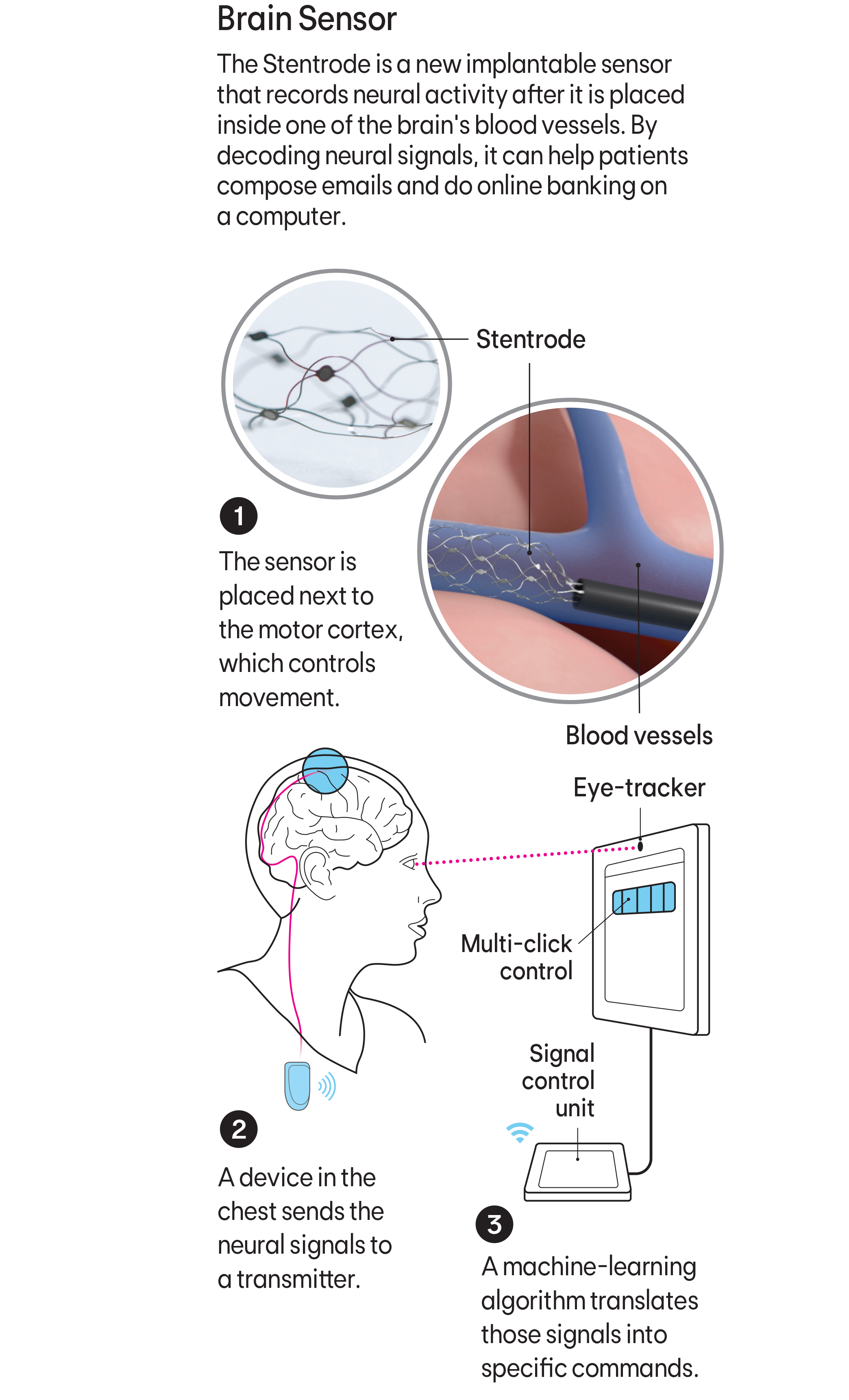 Synchron leading the race for brain computer interface